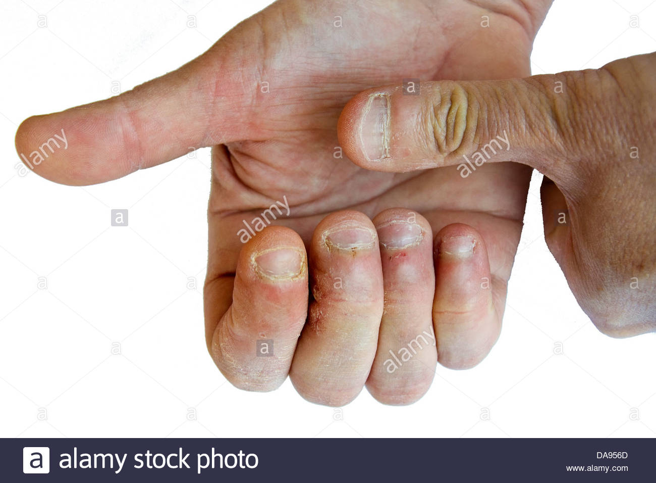 Bitten Nails High Resolution Stock Photography and Images - Alamy