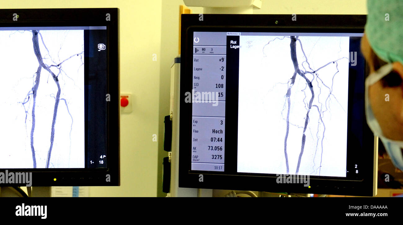 Prof Dr Dierk Scheinert presents a stent covered with medicine to be ...