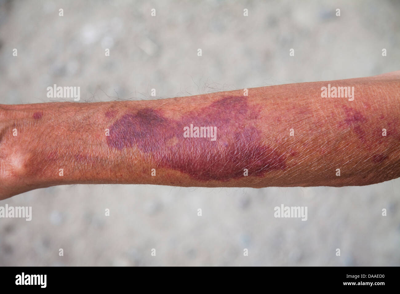 Arm with blood outpouring Stock Photo - Alamy