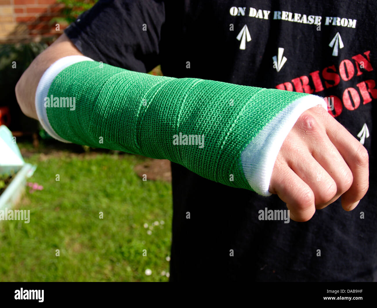 External fixation hi-res stock photography and images - Alamy