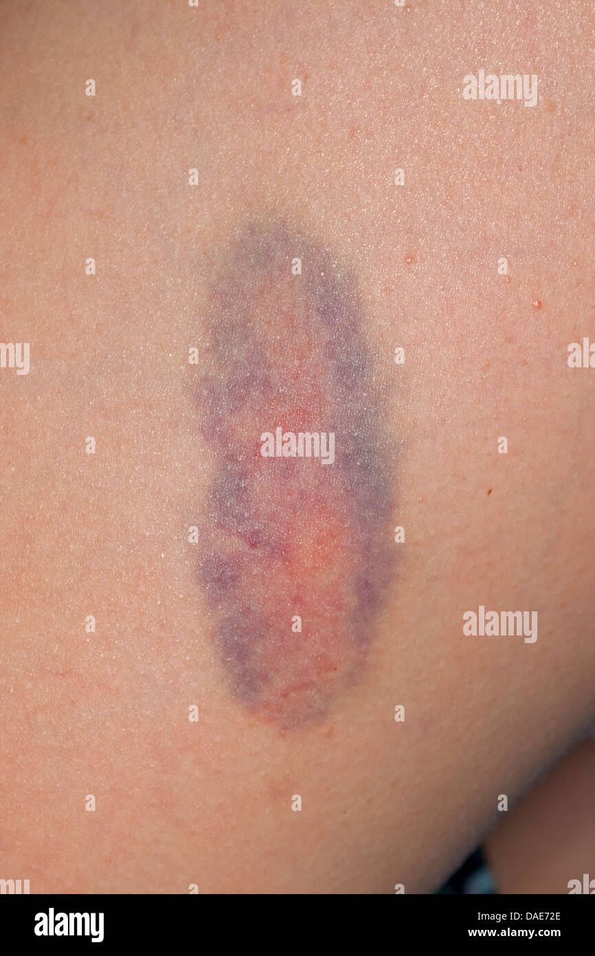 Child abuse bruise hi-res stock photography and images - Alamy