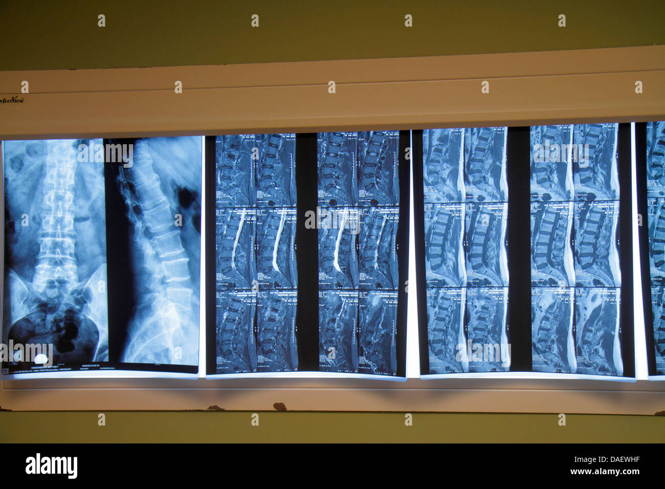 Slipped disc x ray hi-res stock photography and images - Alamy