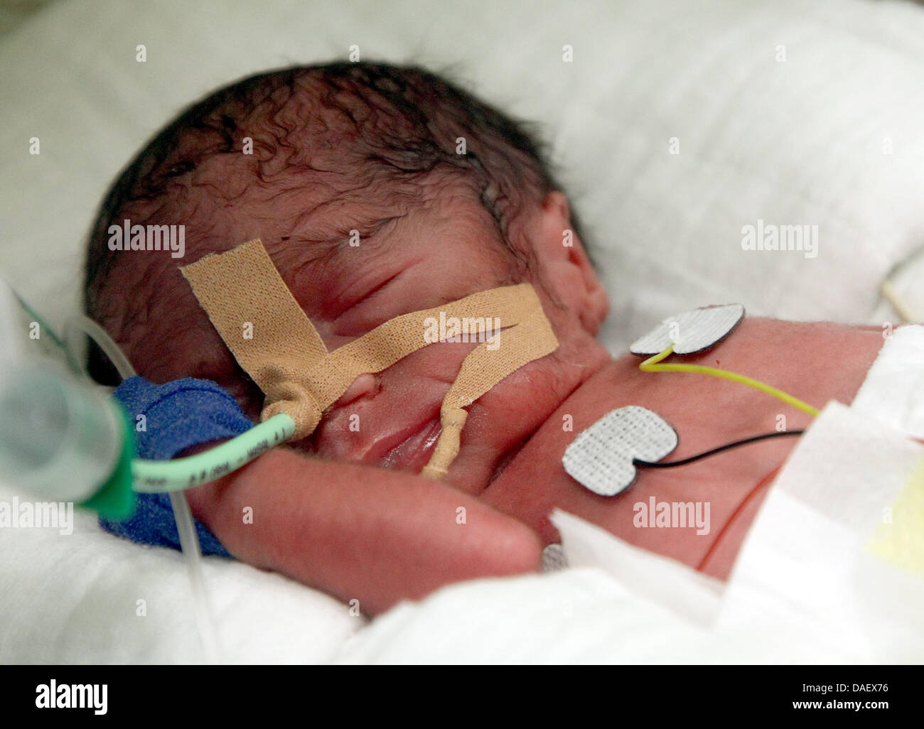 Hidir Ilyaz Fakhro lies in an incubator at the Virchow Hospital of the ...