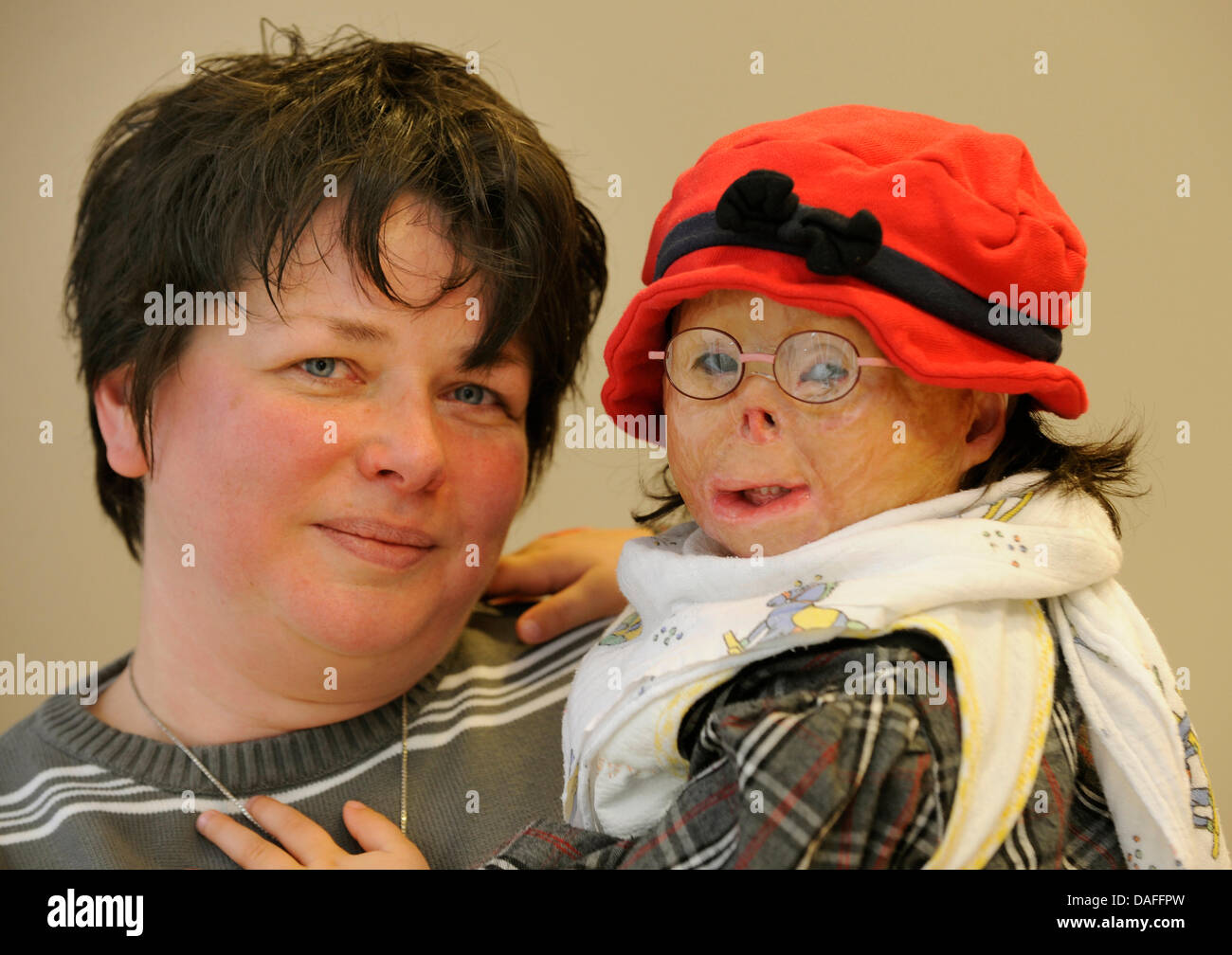 A fire victim, the Iraqi three-year-old girl Maryam and her foster ...