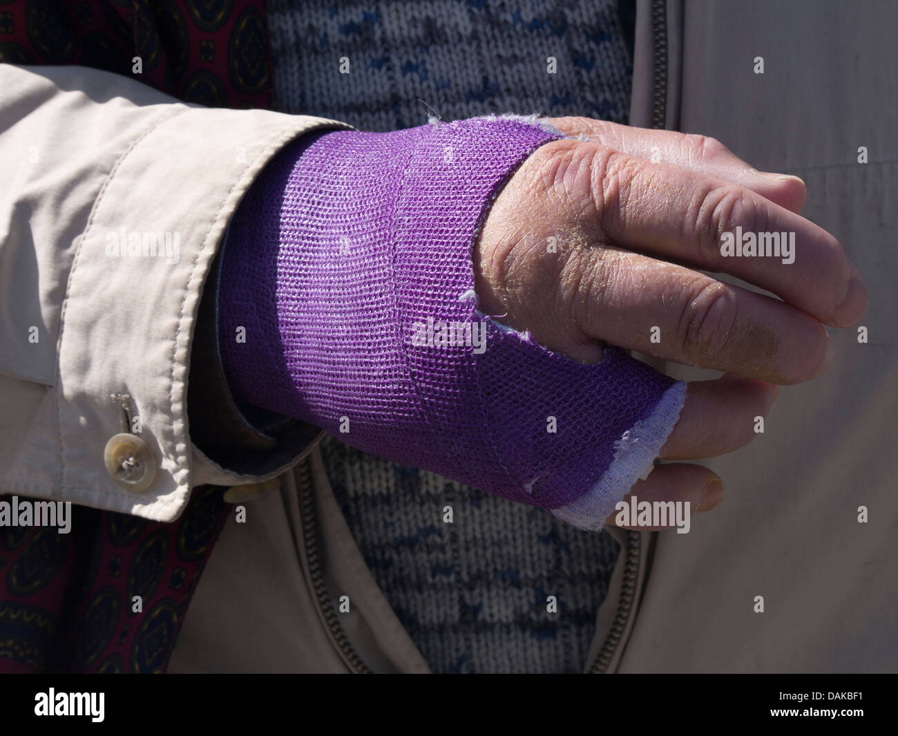 Broken finger hi-res stock photography and images - Alamy