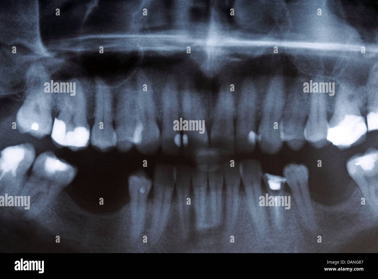 Panoramic x-ray image scan of humans teeth Stock Photo - Alamy
