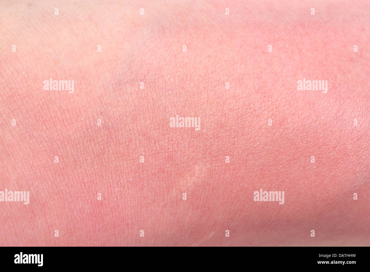 Heat rash sunburn hi-res stock photography and images - Alamy