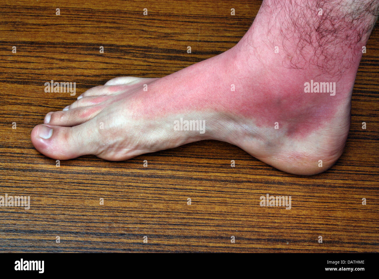 Heat rash sunburn hi-res stock photography and images - Alamy