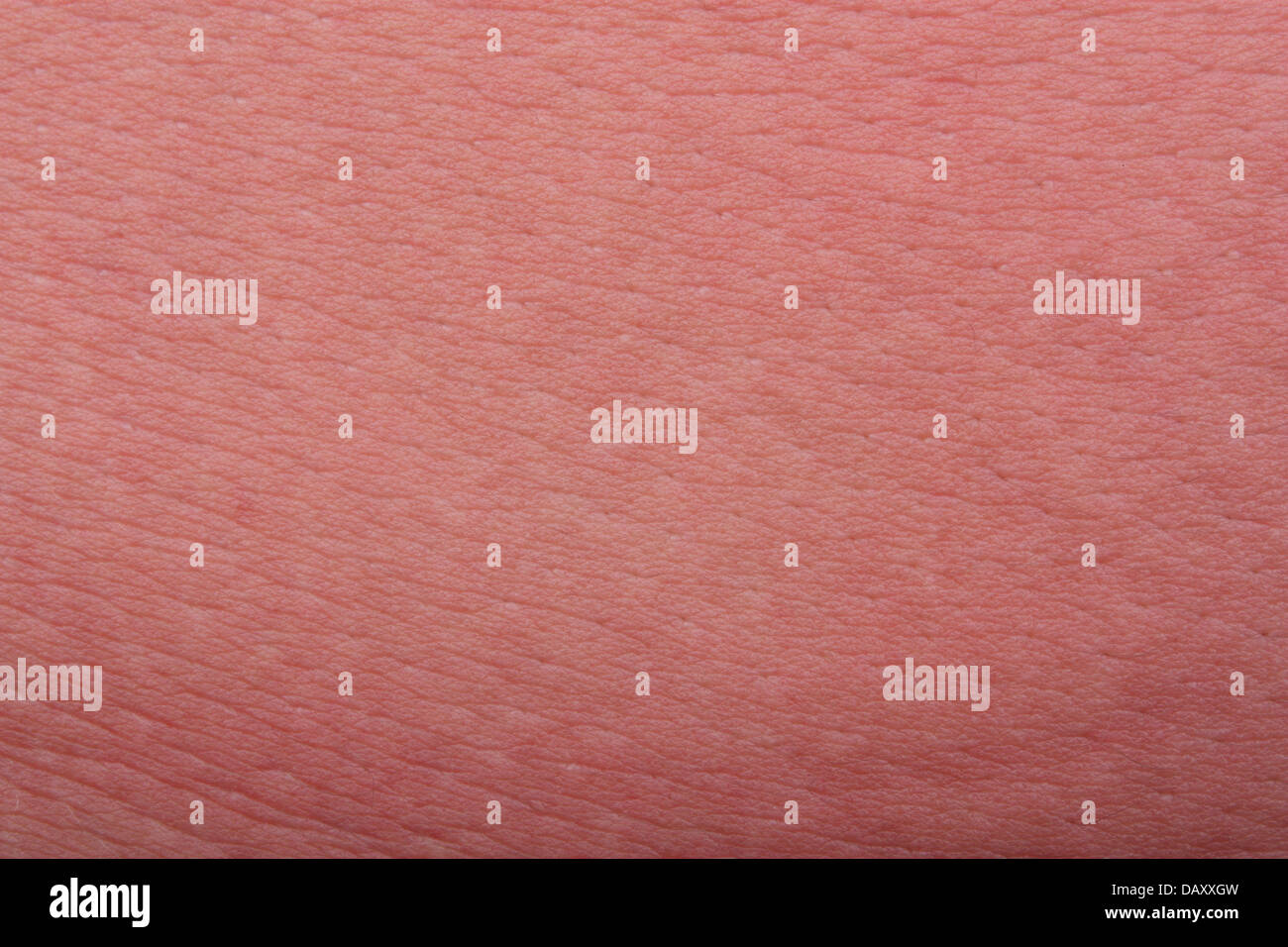 Heat rash sunburn hi-res stock photography and images - Alamy