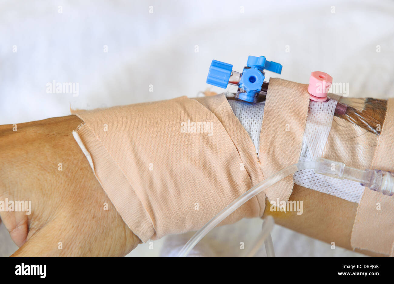 Artery catheterization on patient arm Stock Photo - Alamy