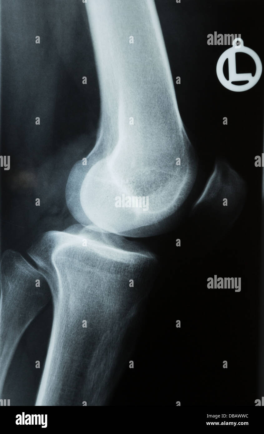 Kneecap hi-res stock photography and images - Alamy