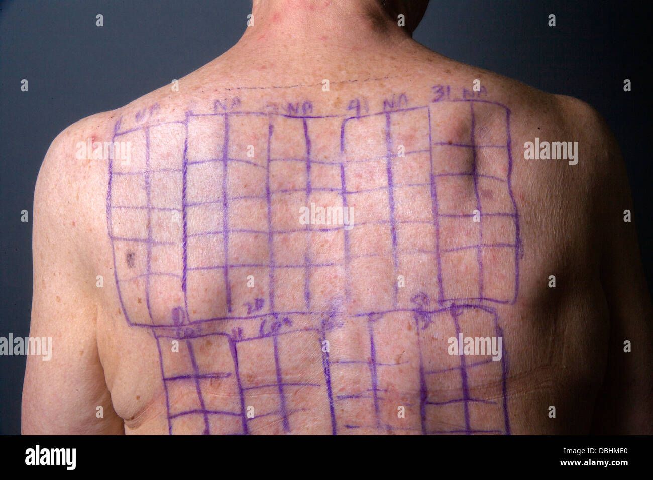 A woman patient's back is drawn with squares indicating locations for ...