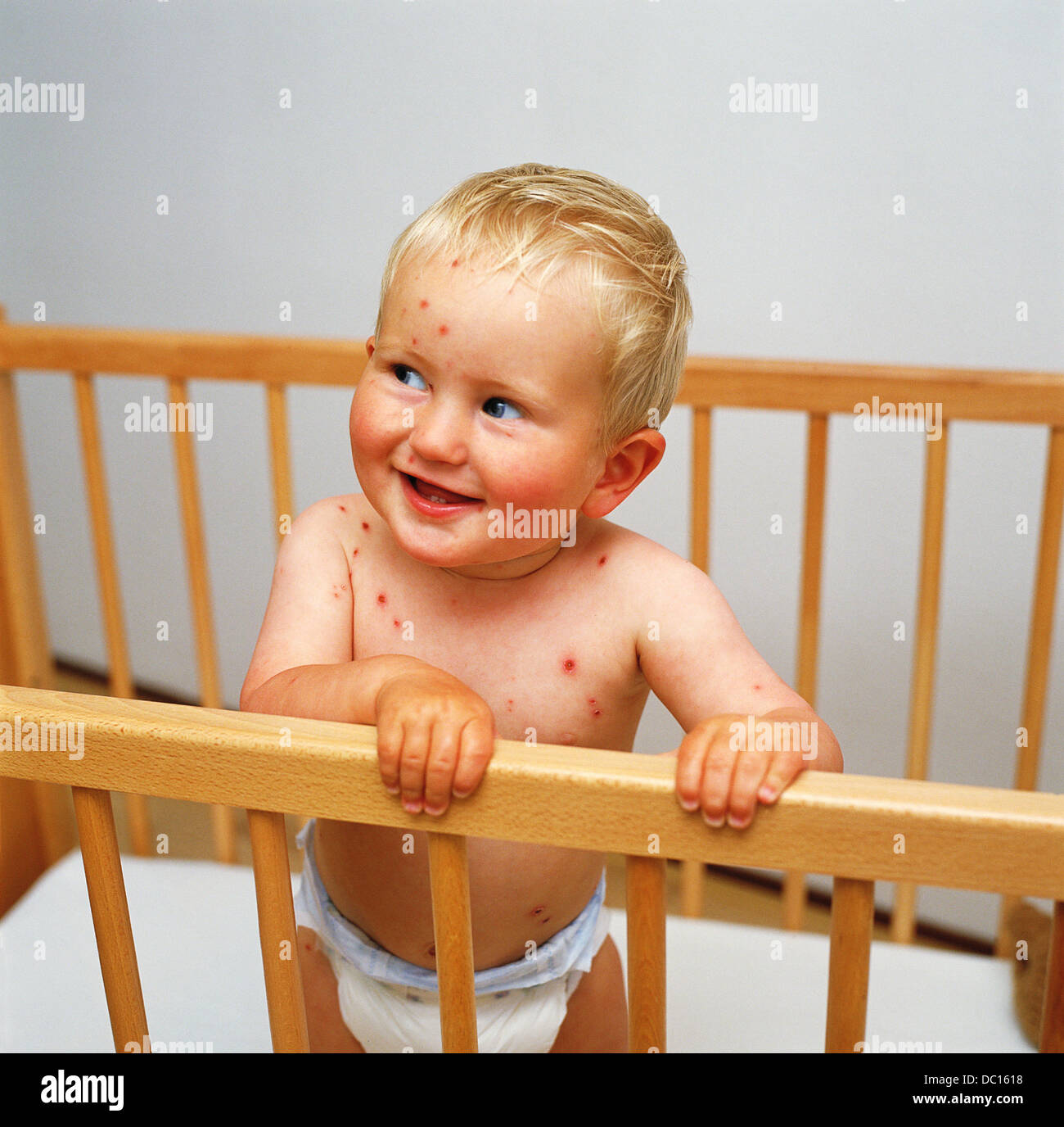 Pox image hi-res stock photography and images - Alamy