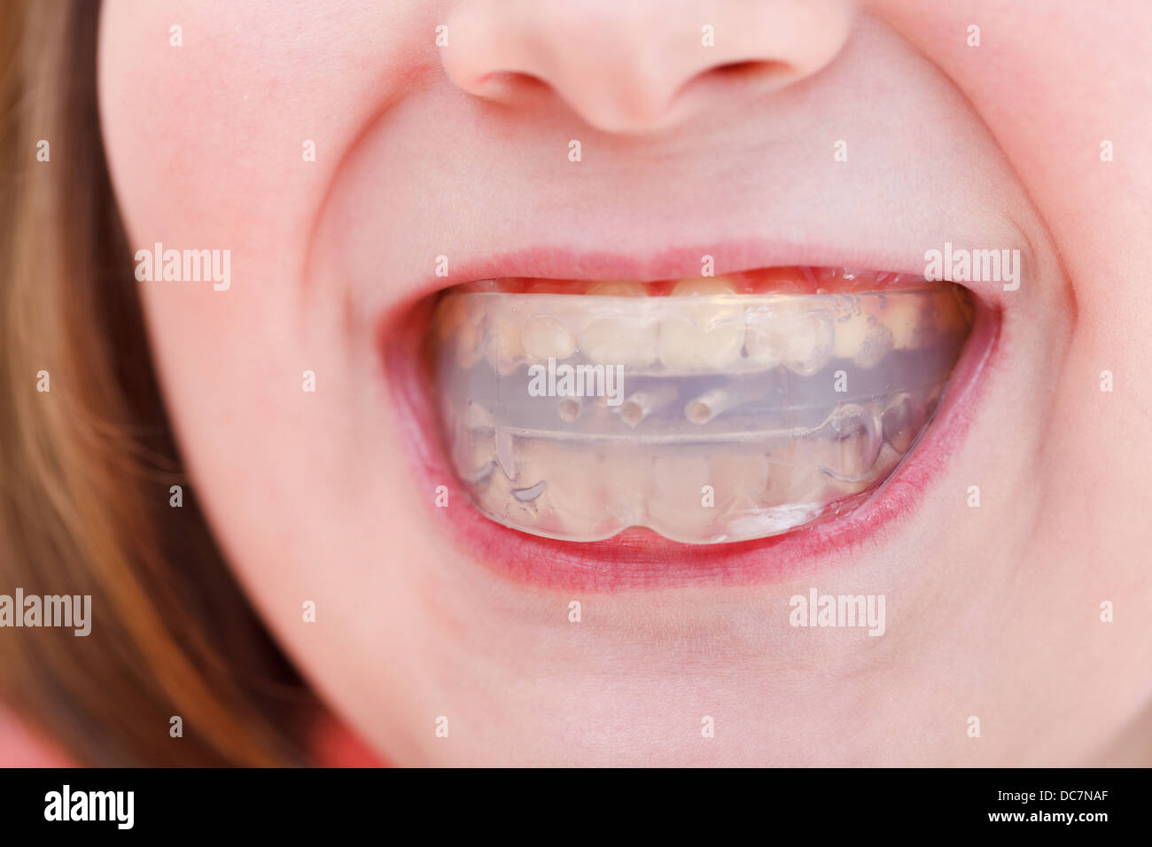 correction of children occlusion by pre-orthodontic trainer Stock Photo ...