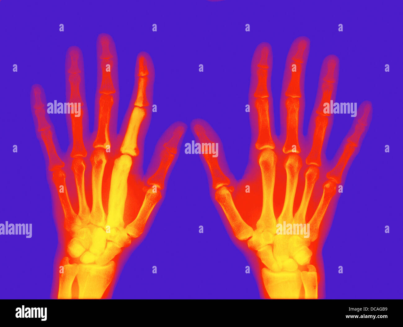 Coloured X-Ray of hands Stock Photo - Alamy