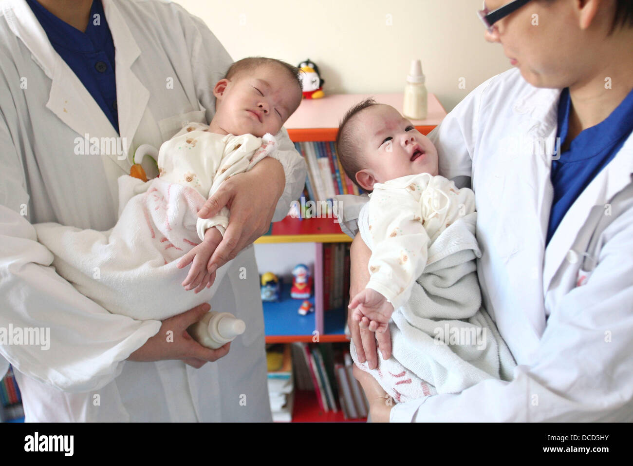 CONJOINED TWINS Four-month-old conjoined twin girls from Zhejiang were ...