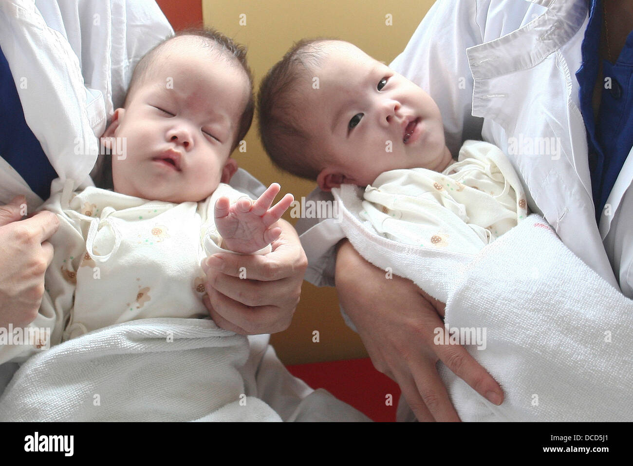 Conjoined Twins Before And After Surgery
