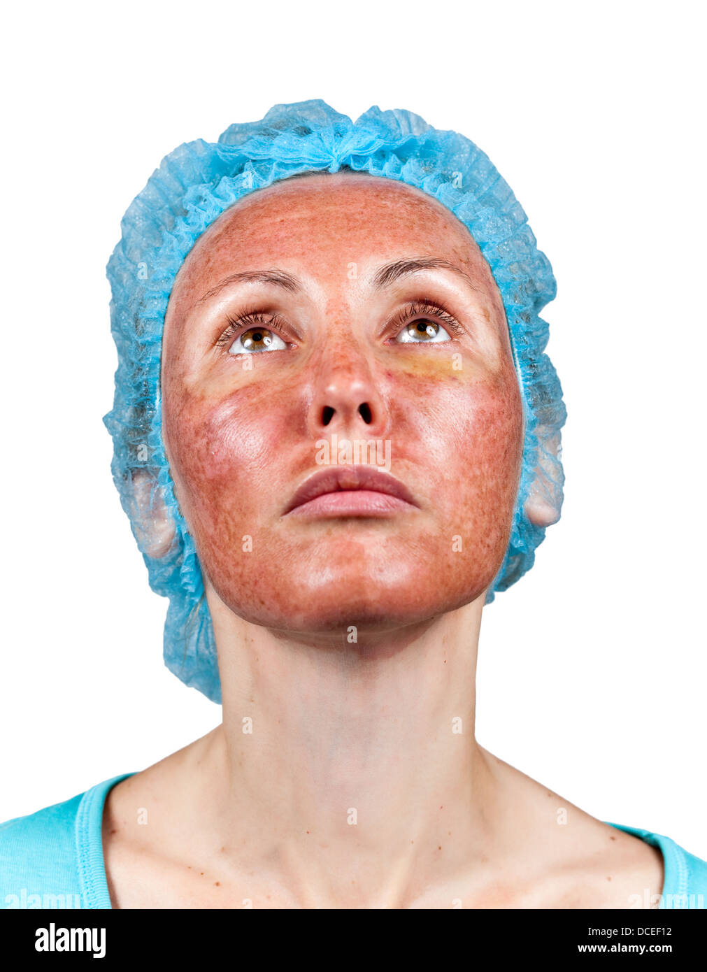 Cosmetology. Skin condition after chemical peeling TCA.top burned layer ...