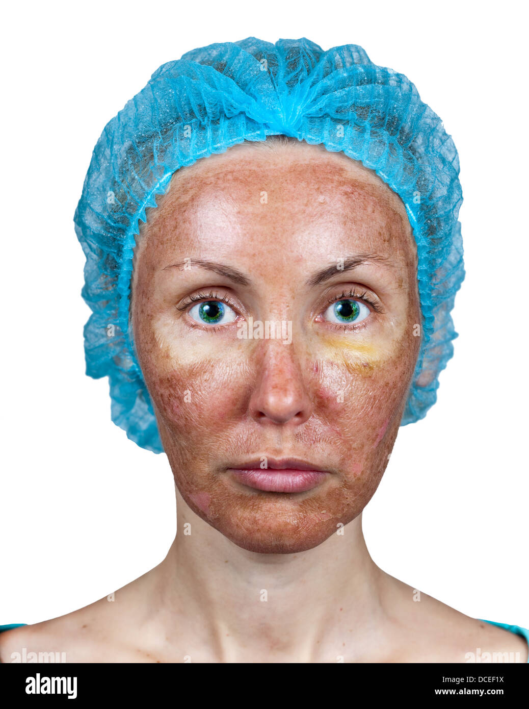 Cosmetology. Skin condition after chemical peeling TCA.top burned layer ...