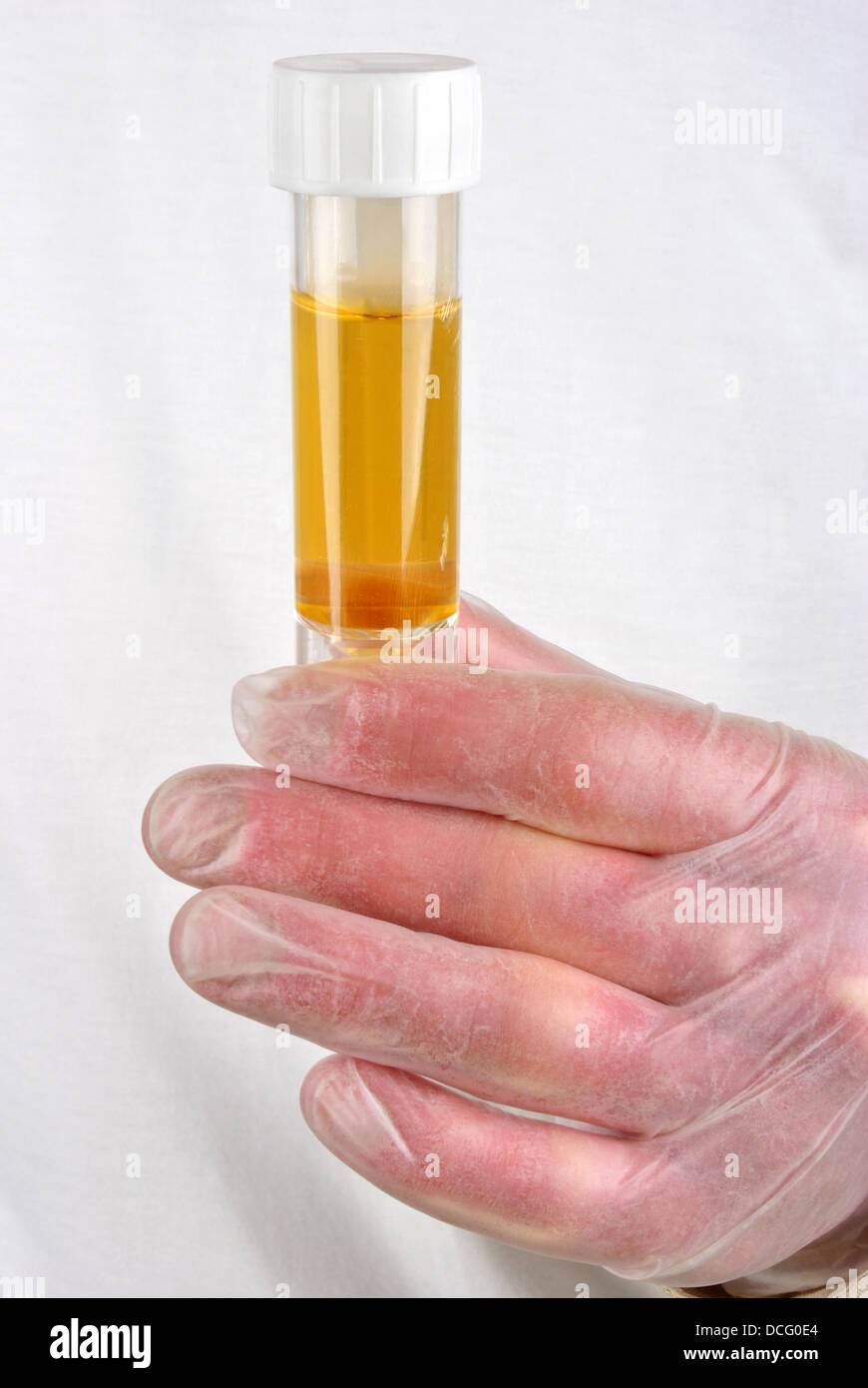 some human urine in a sample bottle Stock Photo - Alamy