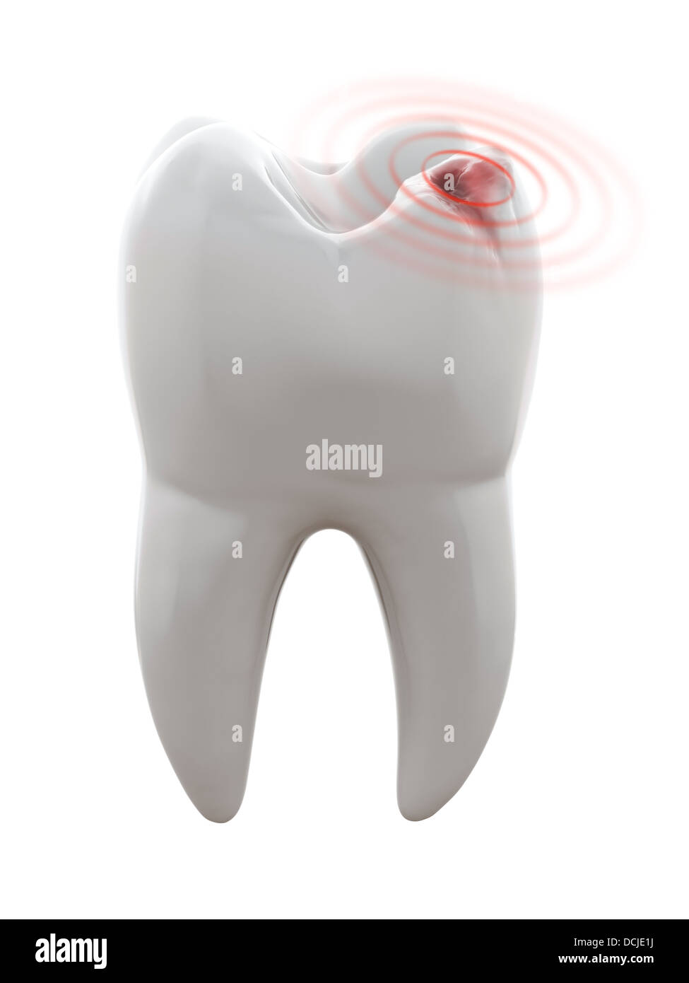 3D illustration of tooth with cavity - Toothache Stock Photo - Alamy