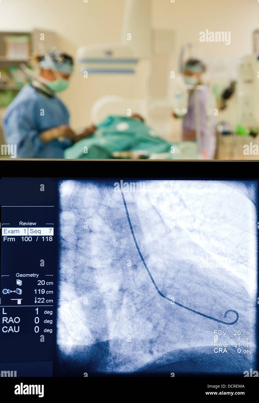 X-ray screen coronarography surgery Stock Photo - Alamy