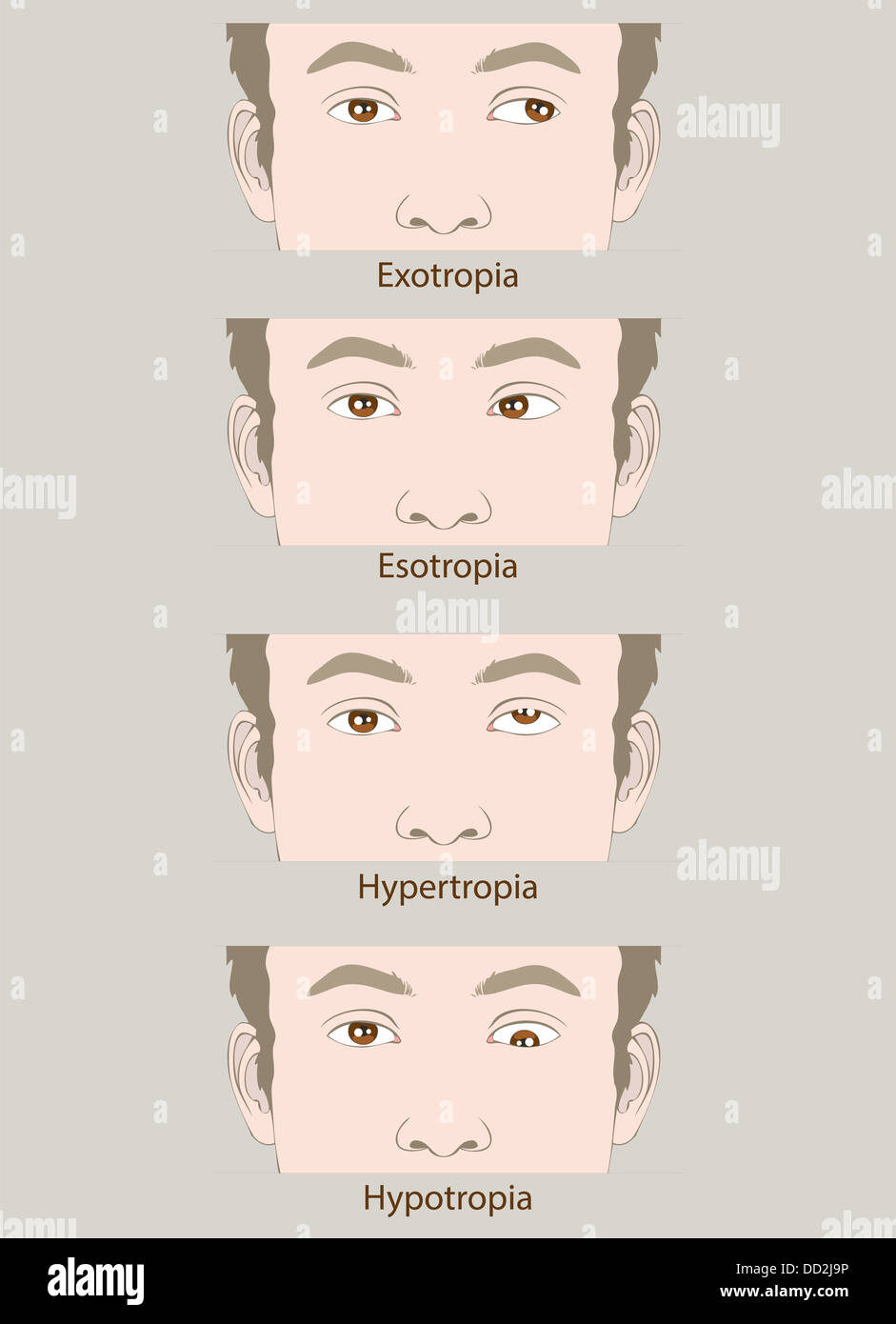 strabismus defect Esotropia, Exotropia, Hypertropia, Hypotropia Stock ...