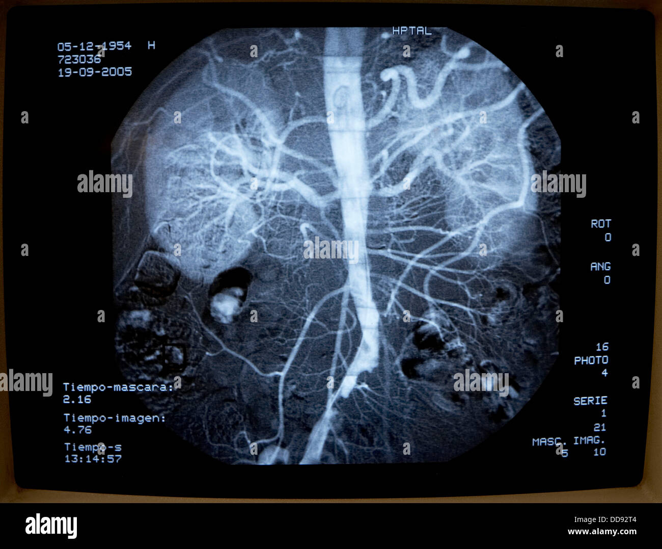 Interventional and vascular radiology hi-res stock photography and ...