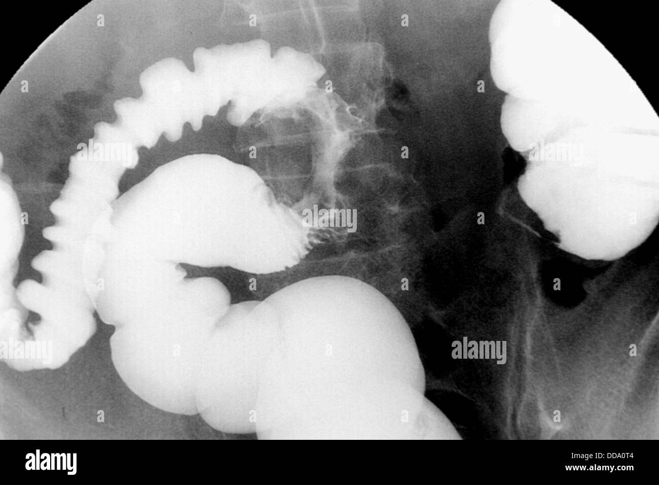 Colon Cancer X Ray Stock Photos & Colon Cancer X Ray Stock Images - Alamy