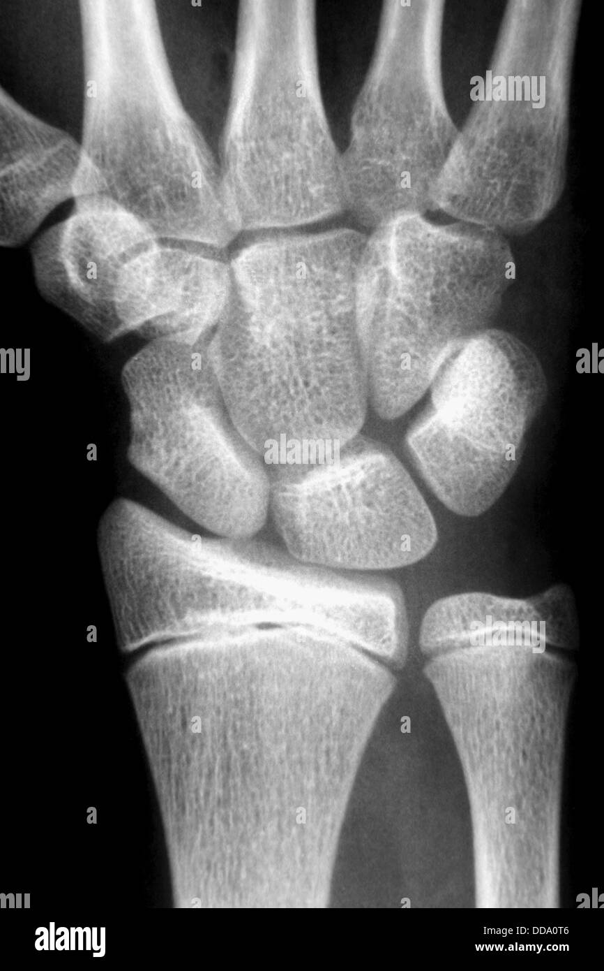 Hand bones hi-res stock photography and images - Alamy