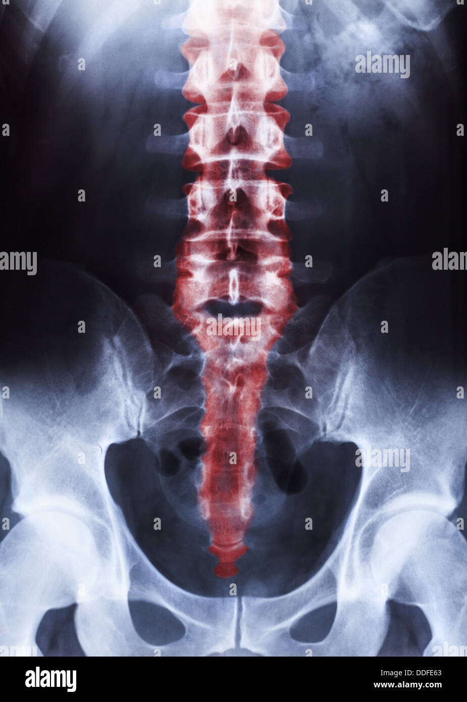 Female back body x ray hi-res stock photography and images - Alamy
