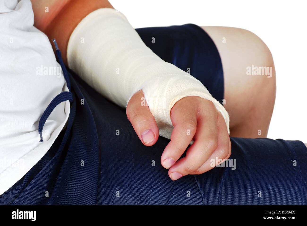 Broken hand in a plaster cast Stock Photo - Alamy