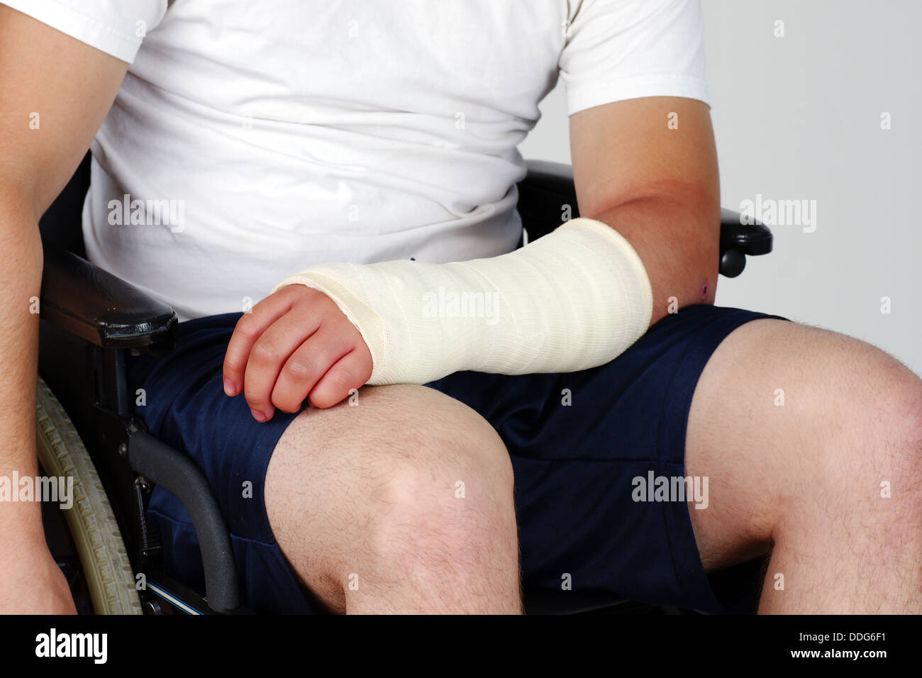 Cast on broken hand Stock Photo - Alamy