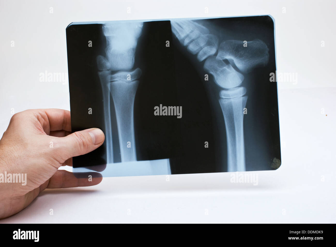 Roentgen hand hi-res stock photography and images - Alamy