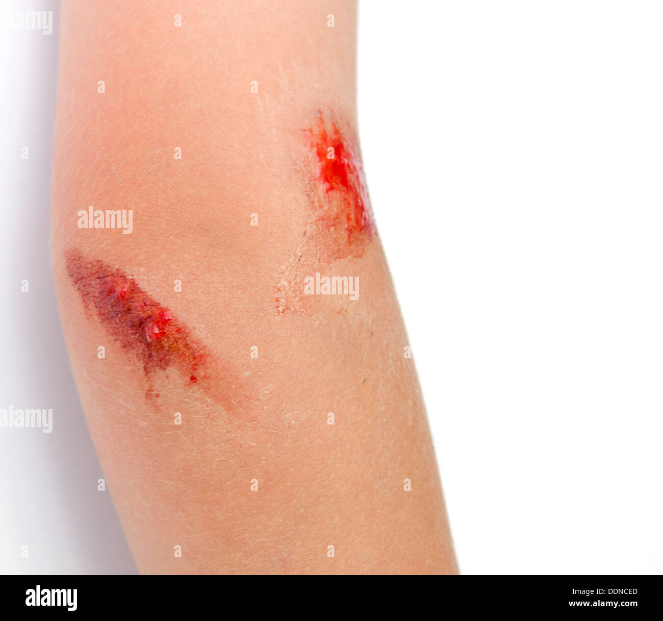 Young Child With injured arm Stock Photo - Alamy