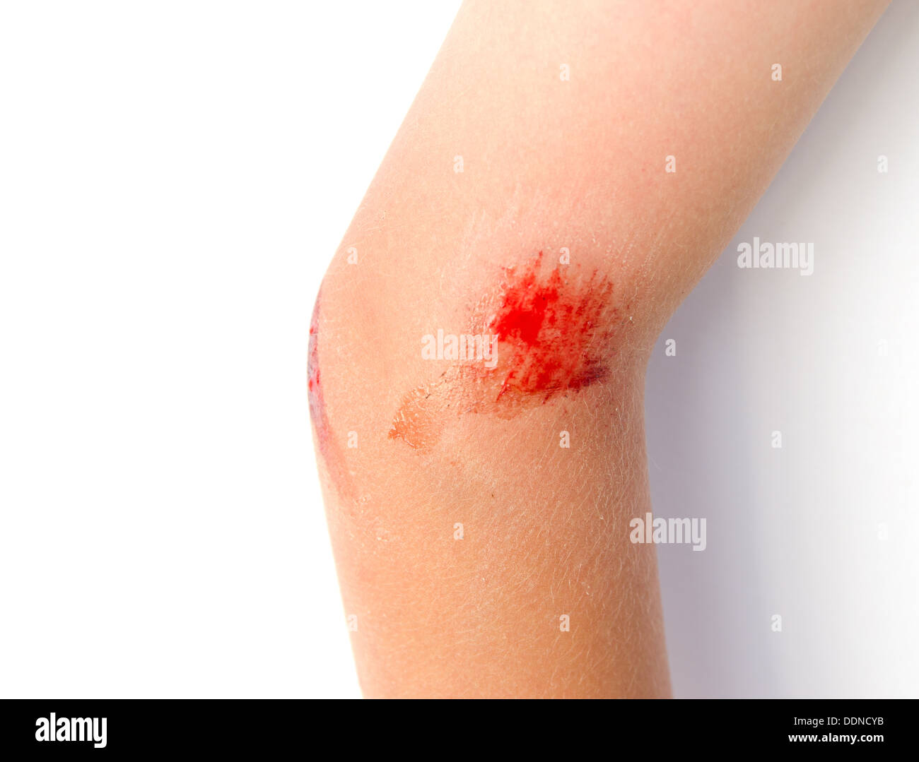 Bruise arm hi-res stock photography and images - Alamy