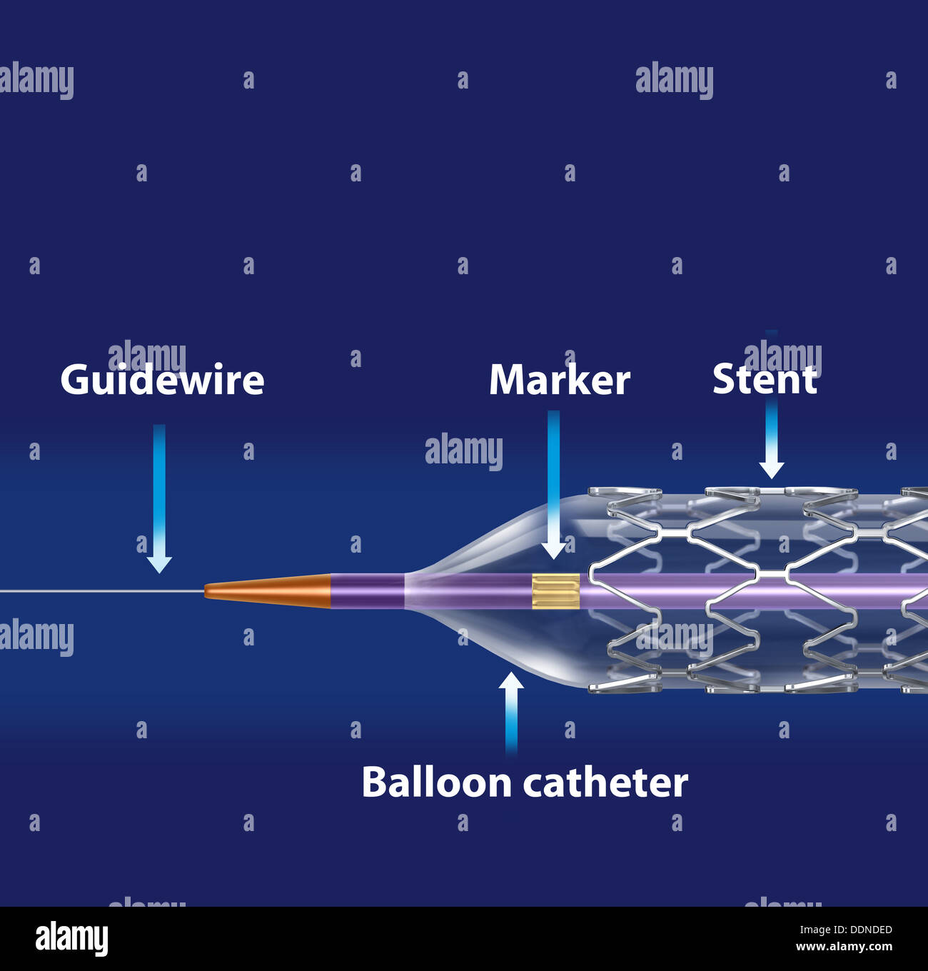 Stent illustration hi-res stock photography and images - Alamy