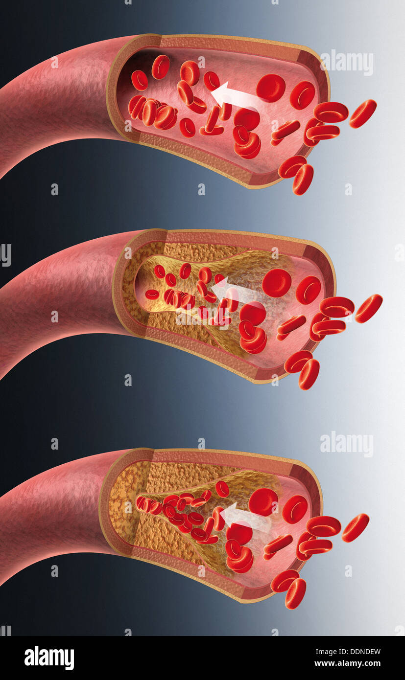 Artery with red blood cells and arteriosclerosis Stock Photo - Alamy