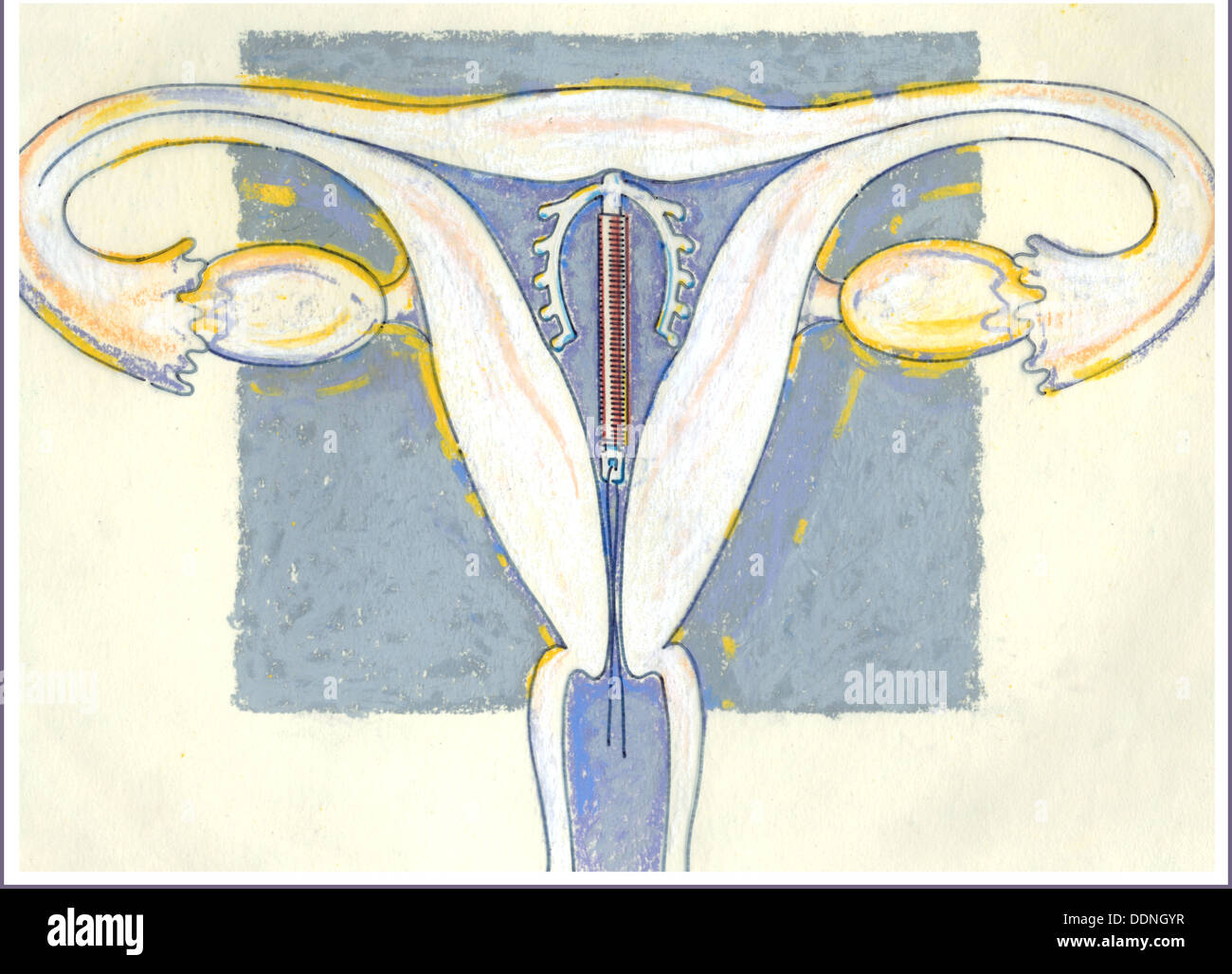 Intrauterine device hi-res stock photography and images - Alamy