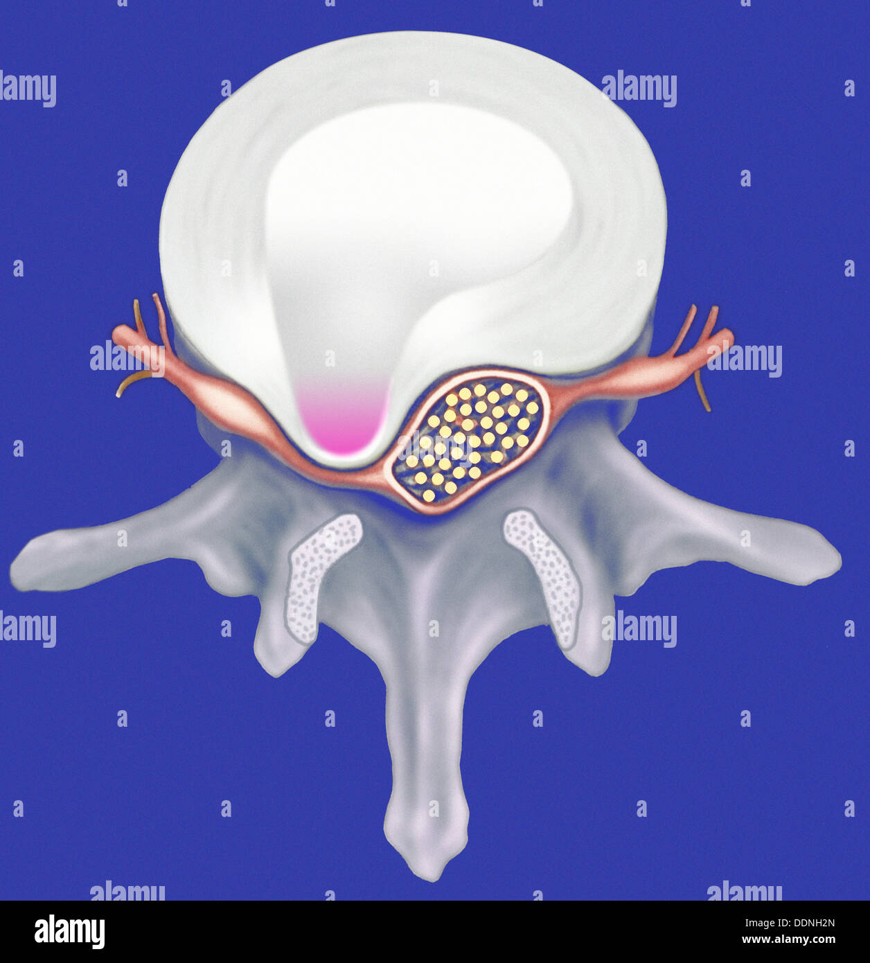Spinal disc herniation hi-res stock photography and images - Alamy