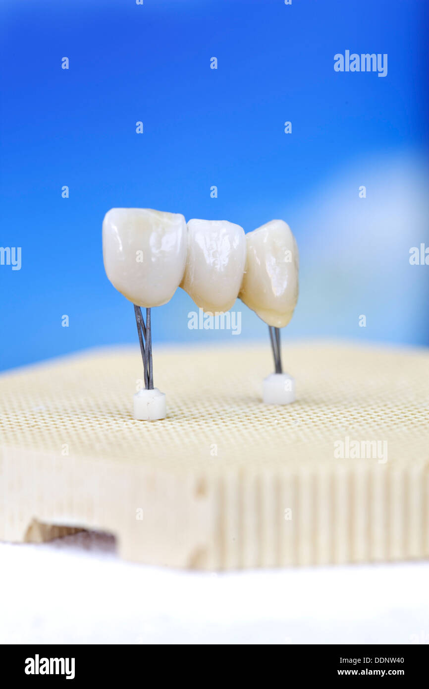 Anterior tooth bridge coming out of furnace for dental Stock Photo - Alamy