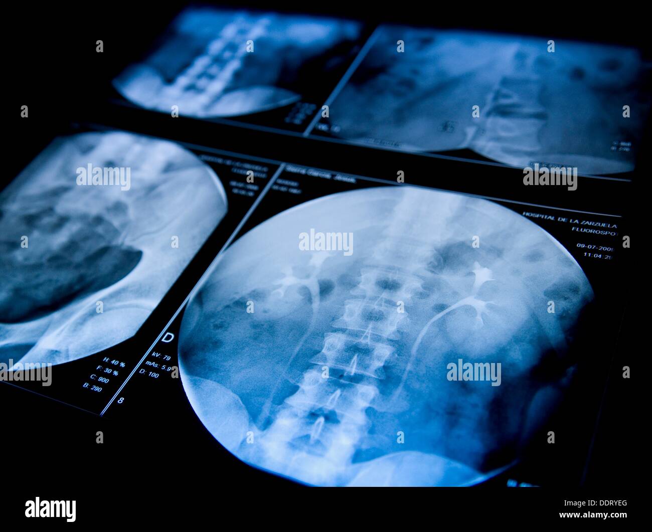 Intravenous pyelogram hi-res stock photography and images - Alamy