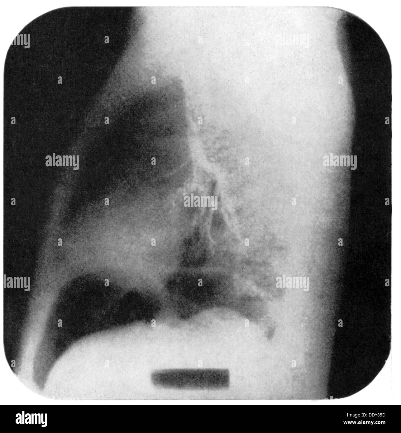 Pneumography hi-res stock photography and images - Alamy