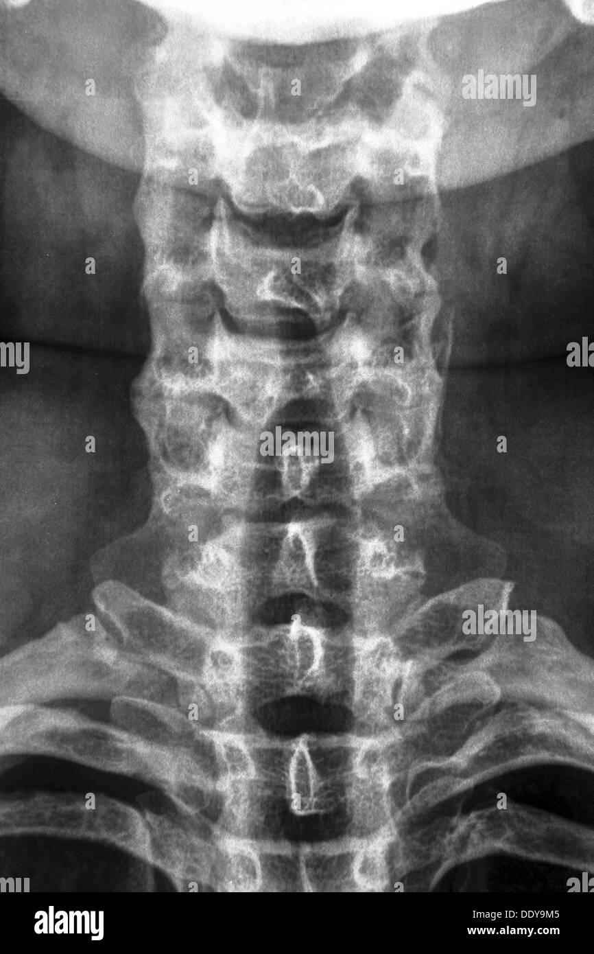 Cervical vertebrae Black and White Stock Photos & Images - Alamy