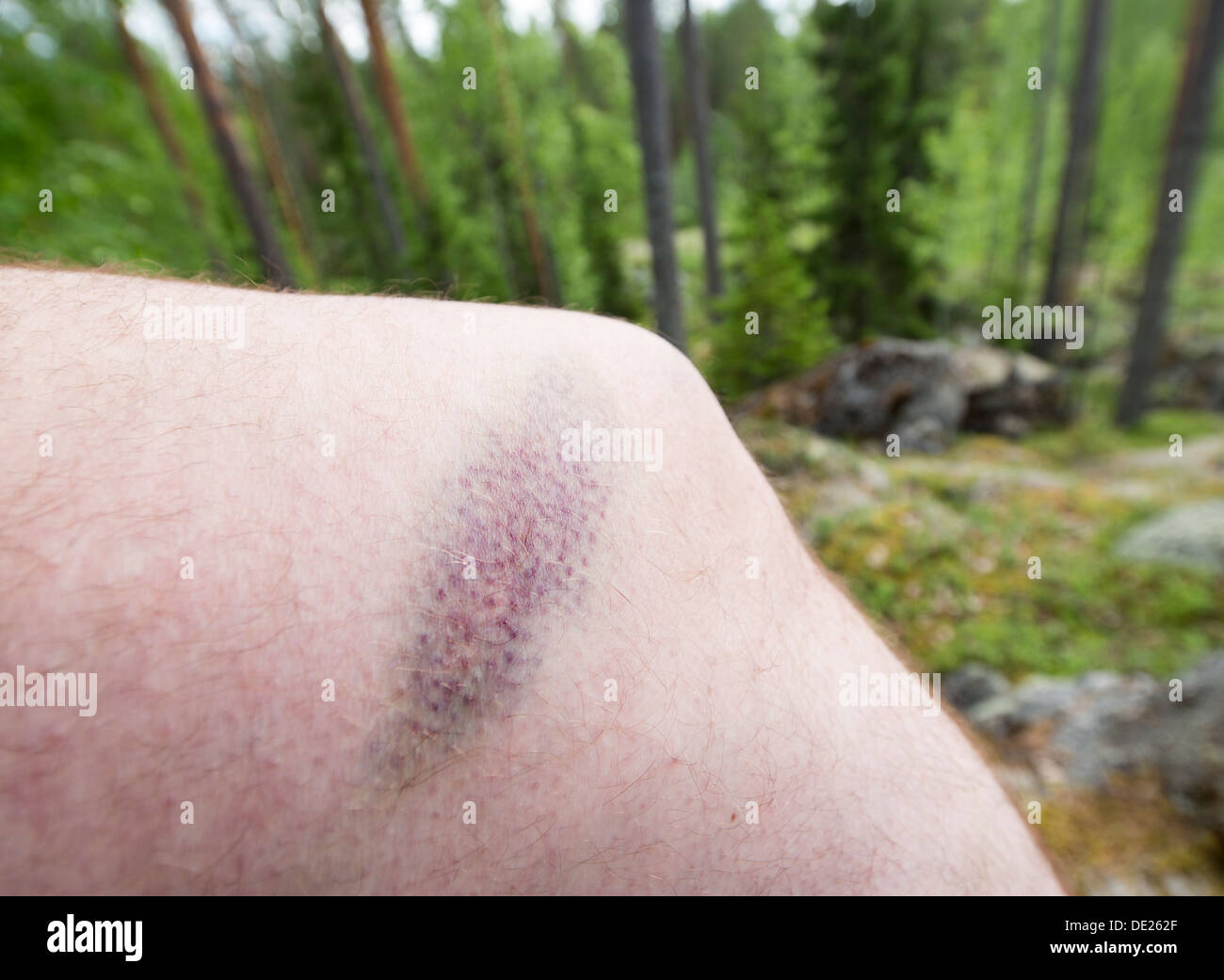 Trekking injury on leg from falling in the forest Stock Photo - Alamy