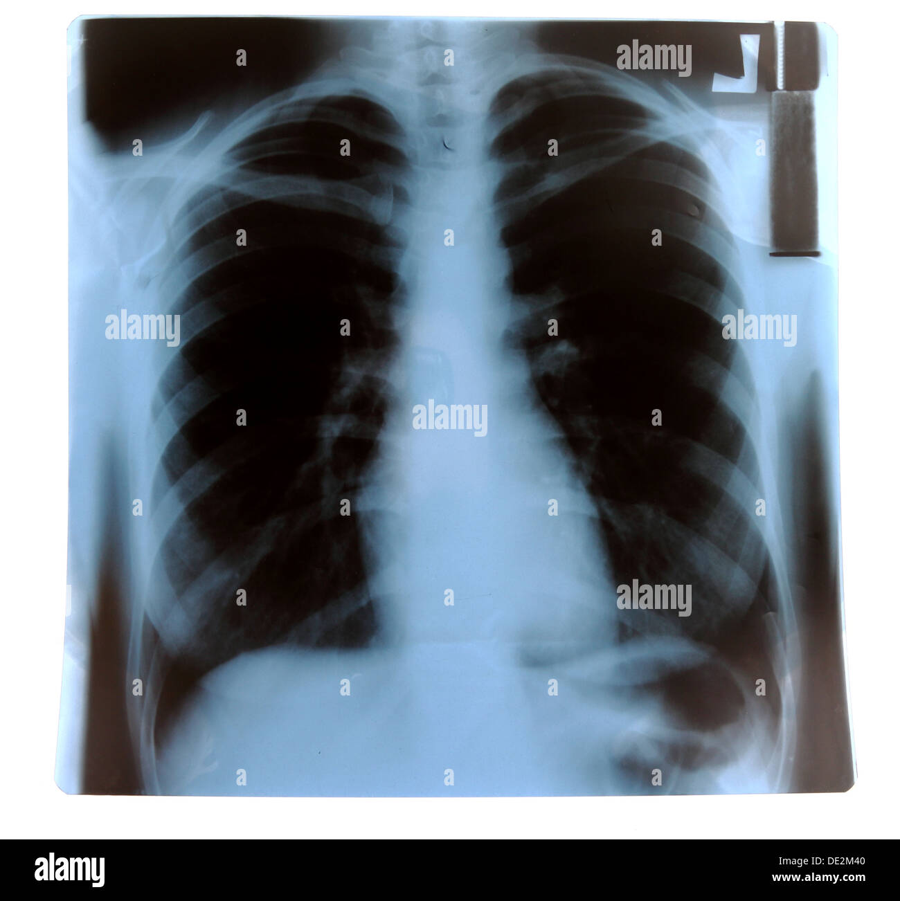 Bronchial tree hi-res stock photography and images - Alamy