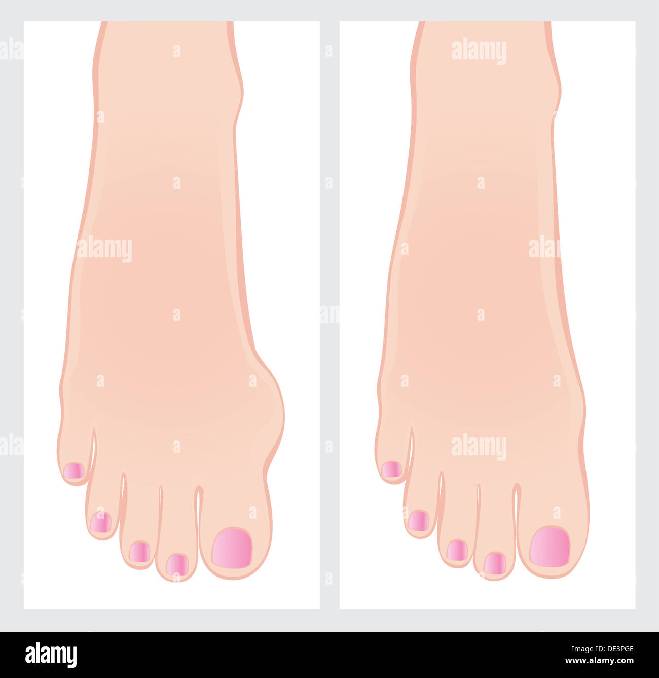 Bunion before and after operation Stock Photo - Alamy