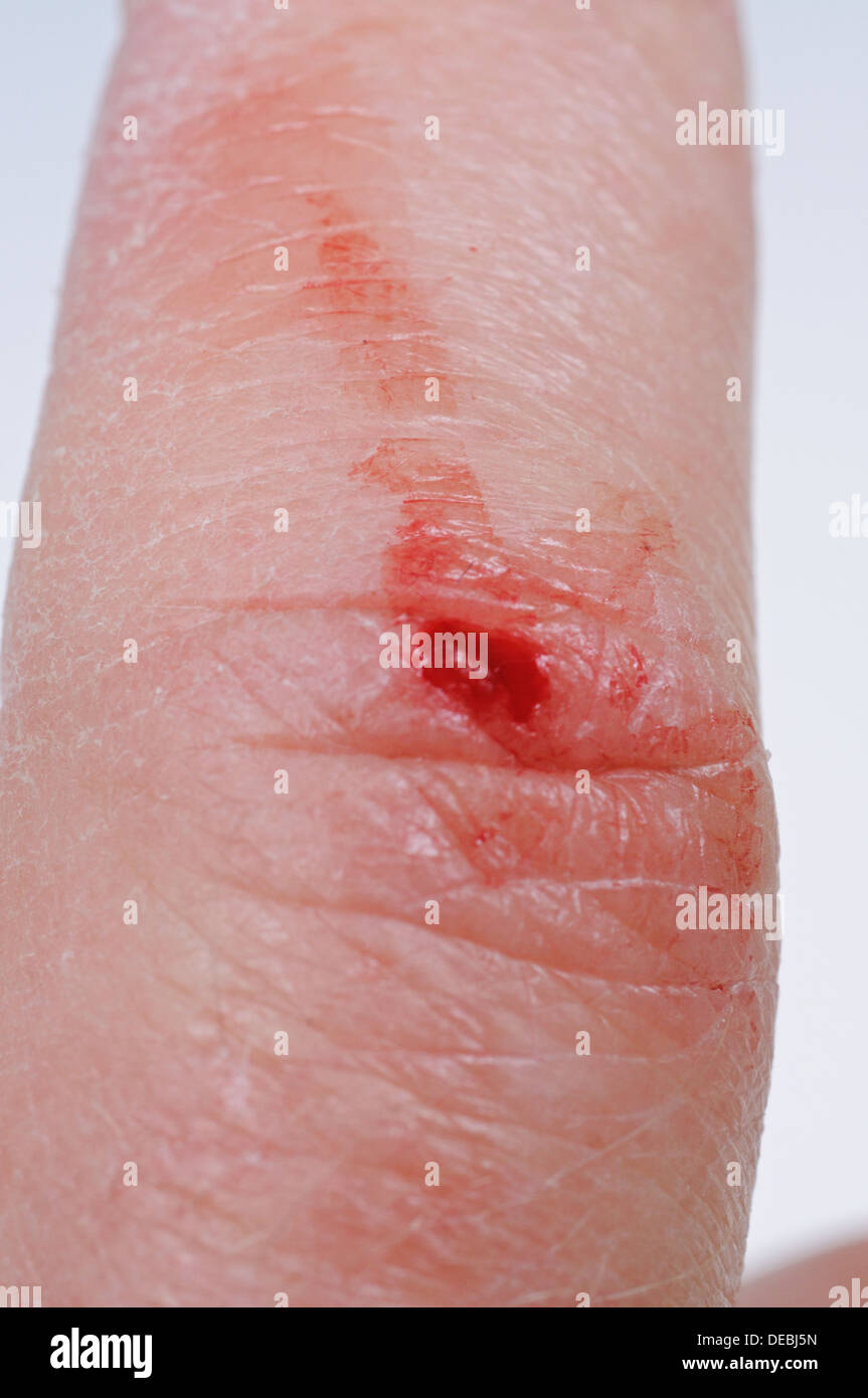 Mans forefinger with a fresh cut Stock Photo - Alamy