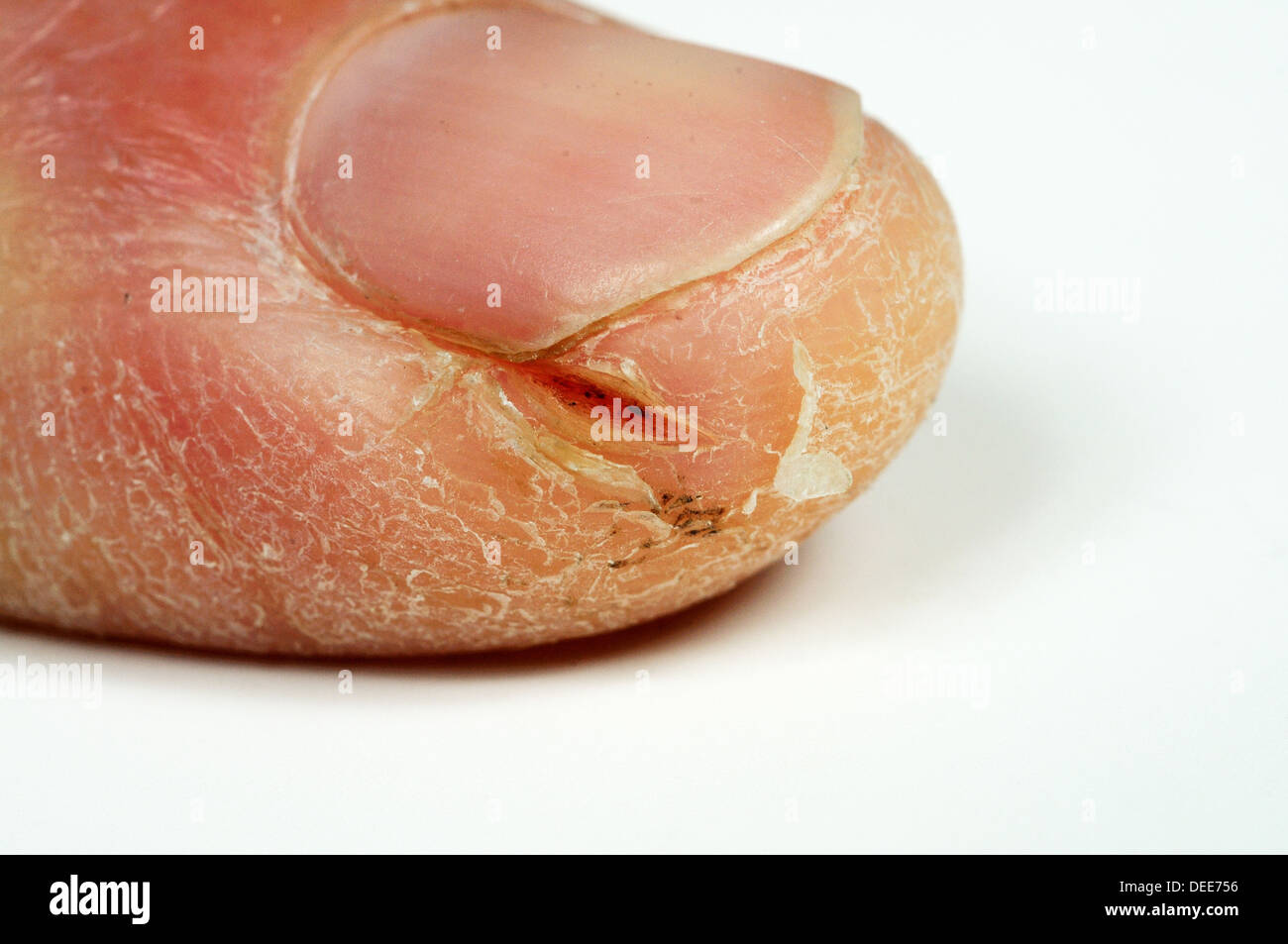 Split finger nails hi-res stock photography and images - Alamy