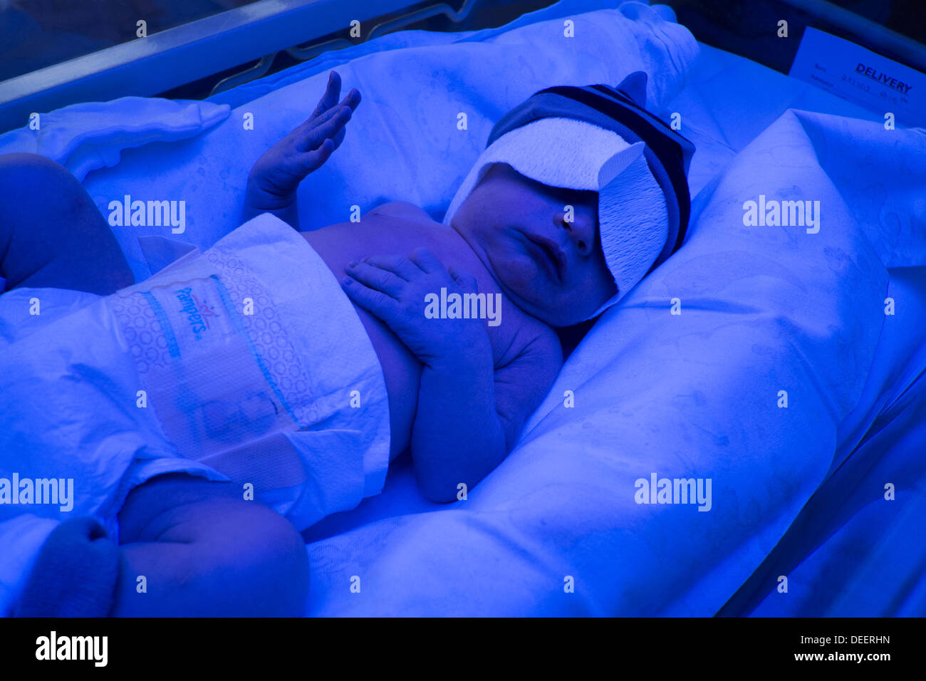 Jaundice Skin Stock Photos & Jaundice Skin Stock Images - Alamy